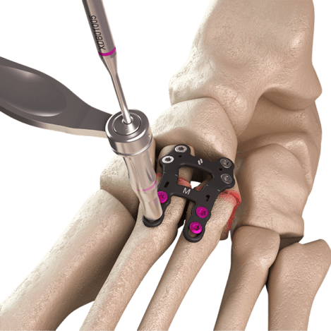 3D Illustrations Minvasys - SYNTHES3D